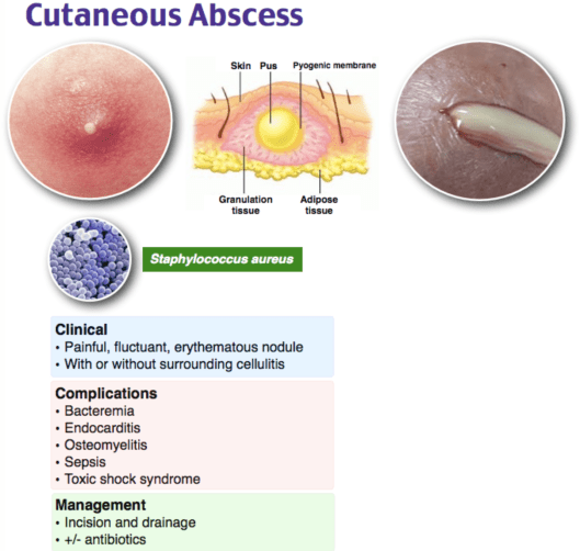 Emergency Medicine Educationem3am Abscess