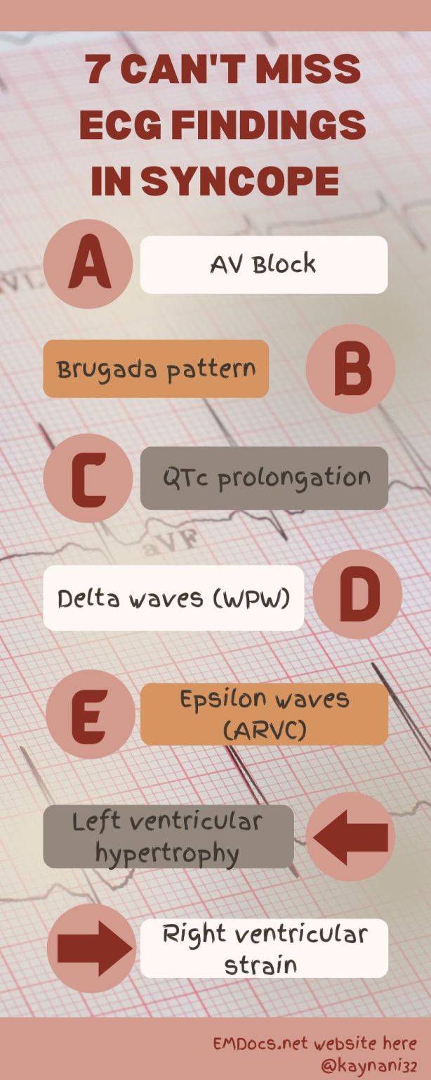 Emergency Medicine Educationecg Pointers 7 Cant Miss Ecg