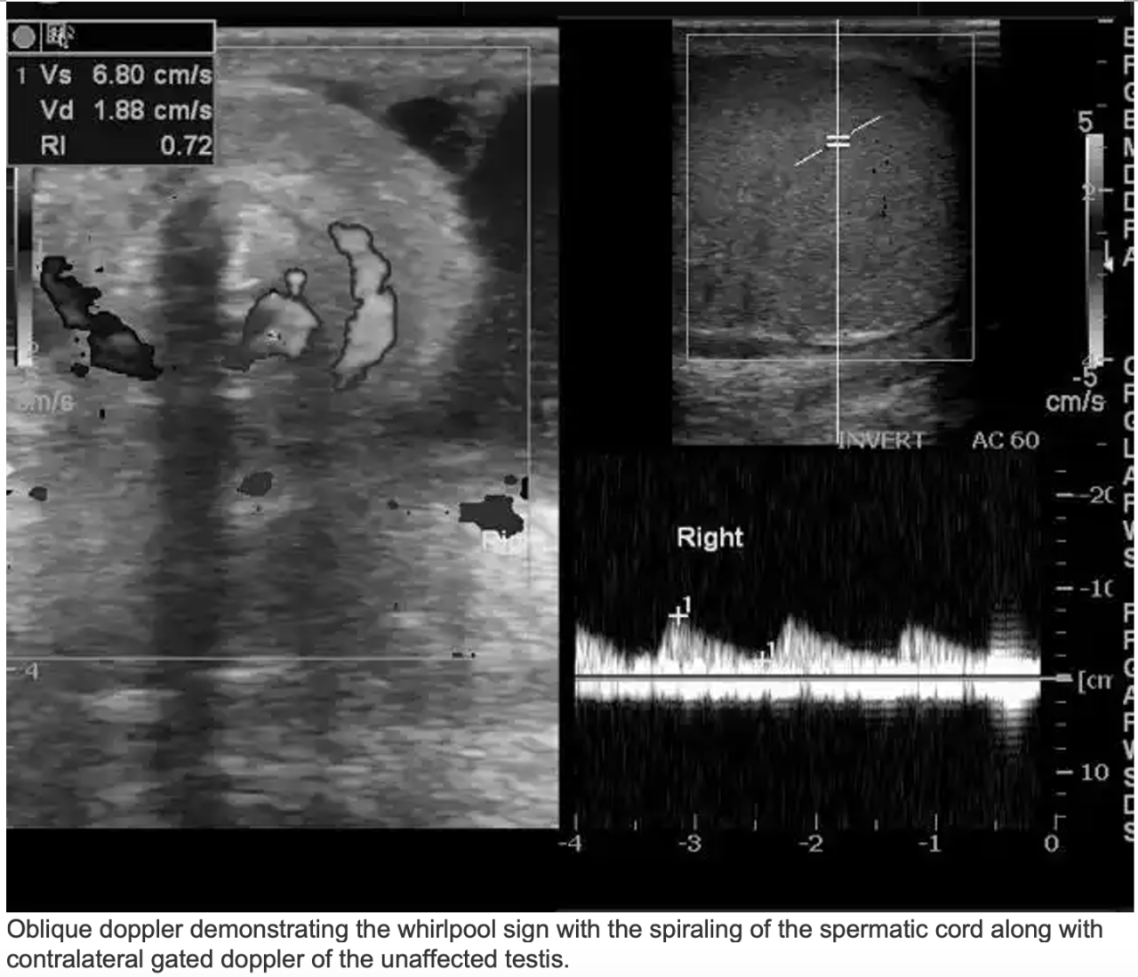 Emergency Medicine Educationem3am Testicular Torsion