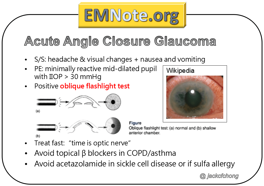 Acute Angle Glaucoma Treatment Prnso