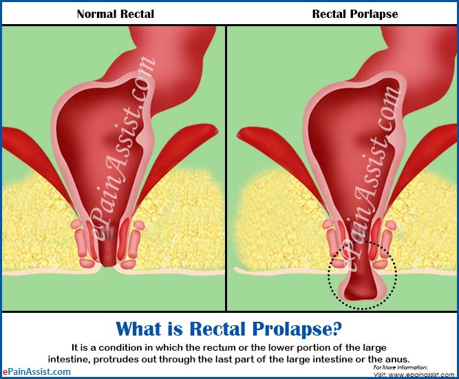 Rectal Prolapse Pelvic Floor Exercises