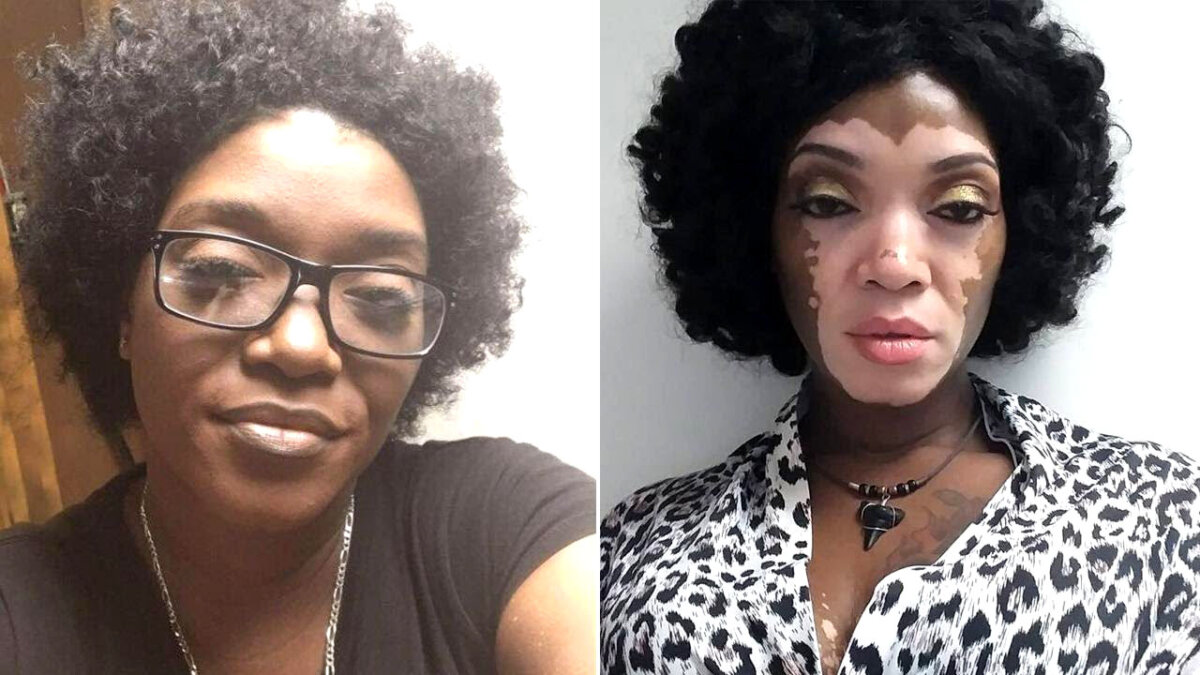 Video Heart Shaped Vitiligo Lady Takes Make Up Off After 30 Years Of