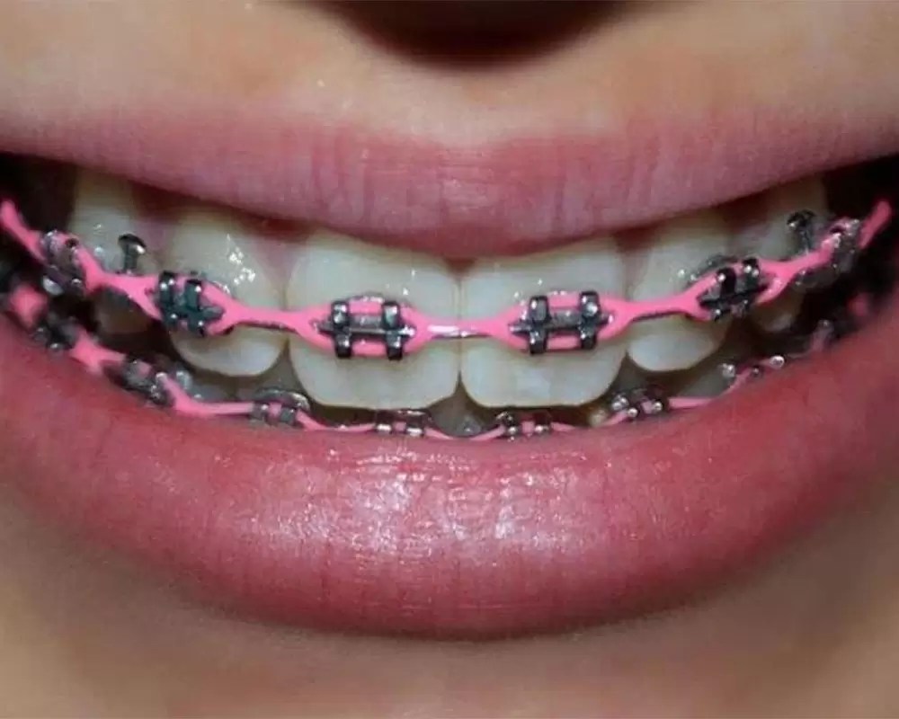 Braces Y Cadenas Eléctricas Gibbs Orthodontic Associates 2023