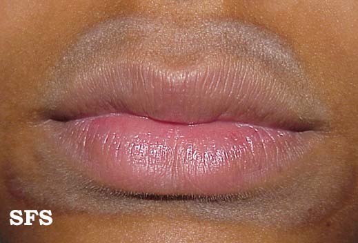 Red Rash Around Lips