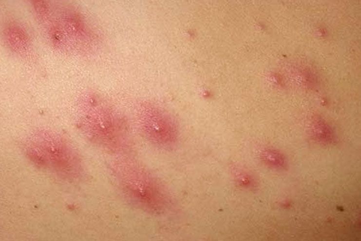 How To Cure Small Itchy Bumps On Skin 2022