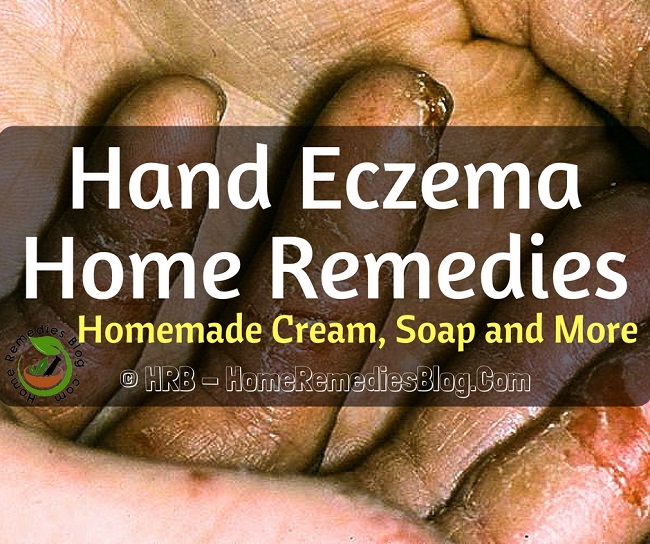 Top 12 Hand Eczema Home Remedies For Fast Recovery Home Remedies Blog