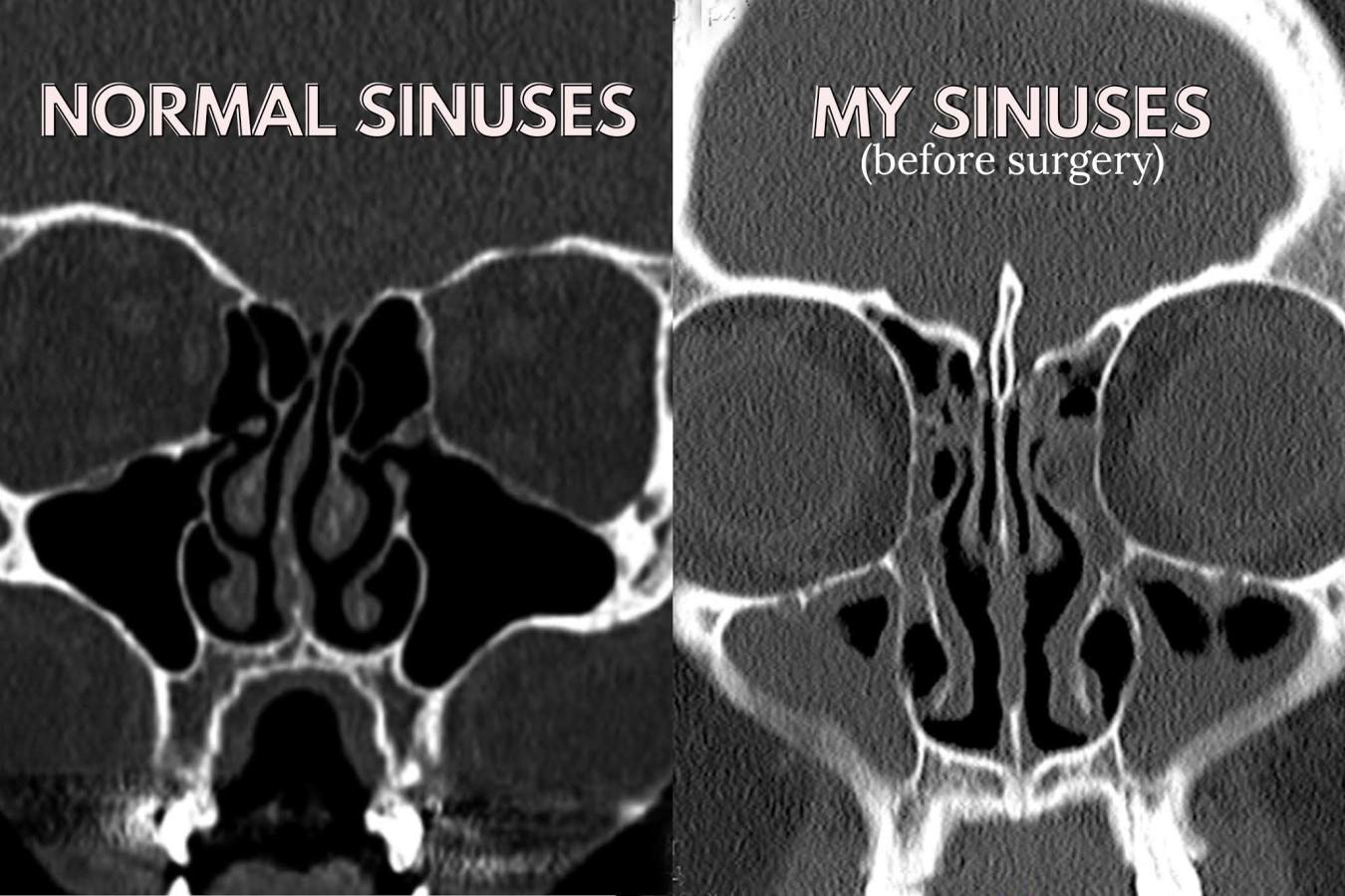 The Truth About Sinus Surgery My Experience Jordan Hepler Lifestyle