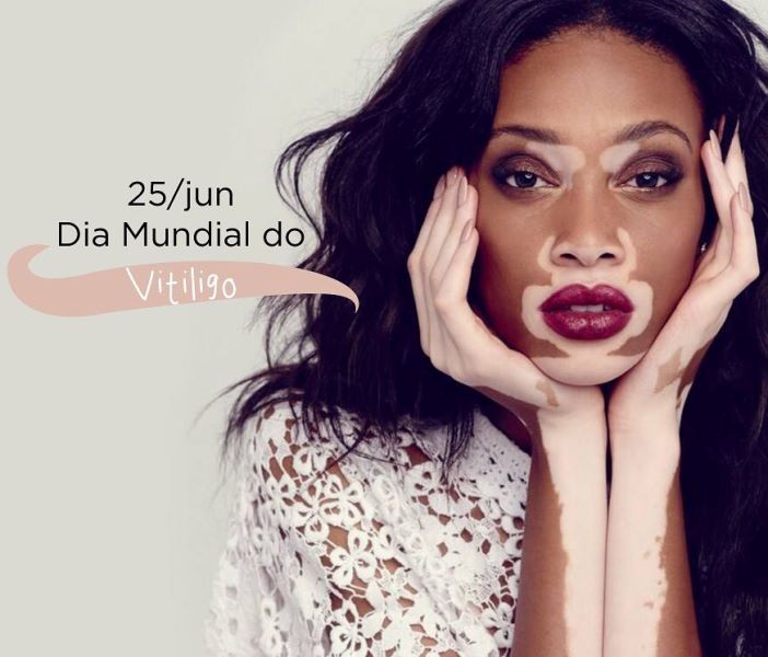 Dia Mundial Do Vitiligo Liege Barbalho