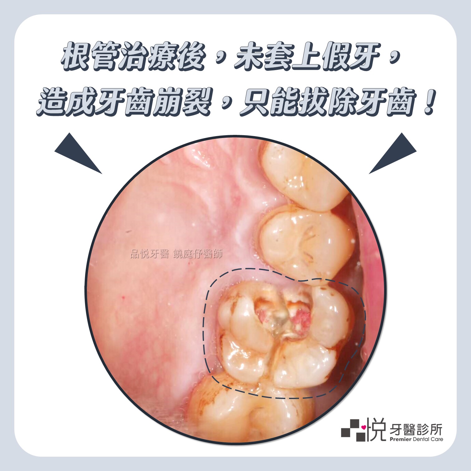 牙齒抽神經後，一定要套假牙嗎？假牙像是根管治療後的安全帽