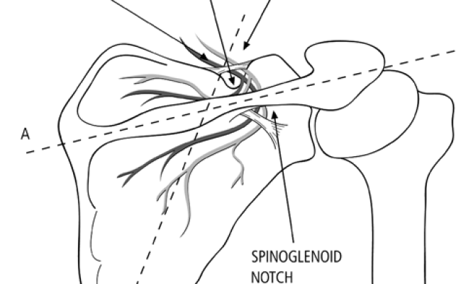 Technique Of Suprascapular Nerve Block Download Scientific Diagram