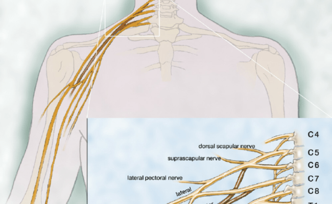 Upper Extremity Peripheral Nerve Blocks Brachial Plex