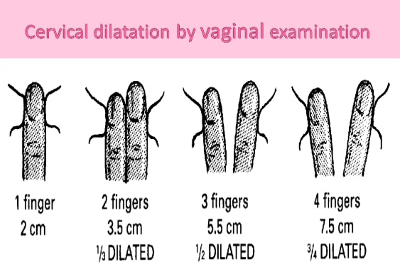 Cervical Dilation Stepwards