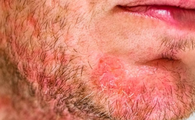 Dermatitis Seborreica Que Es Cuales Son Sus Sintomas Y Como Tratar