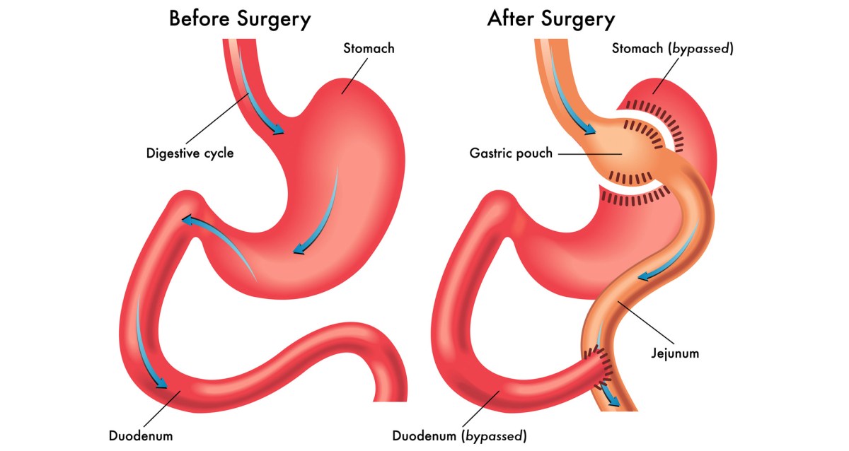 Gastric Sleeve Surgery Turkey Istanbul Medical
