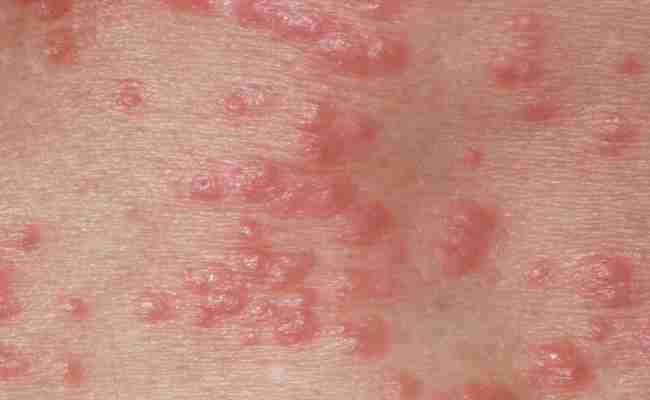 8 Common Types Of Rashes And What They Look Like In 2