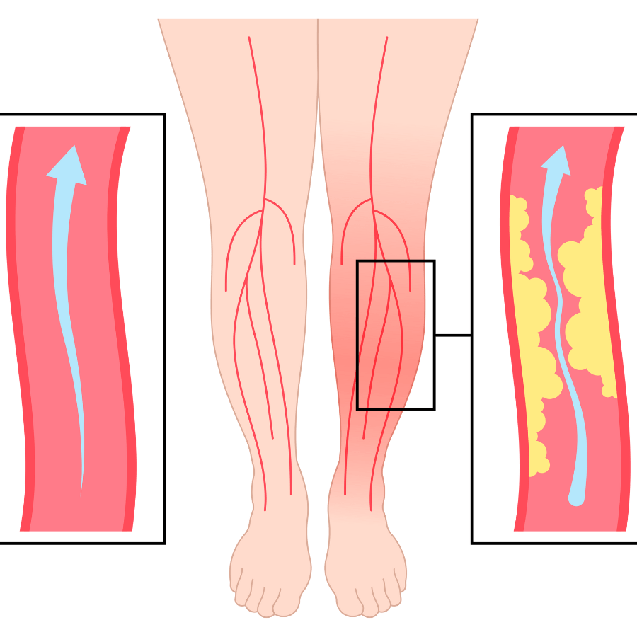 Deep Vein Thrombosis Archives Western Vascular Institute