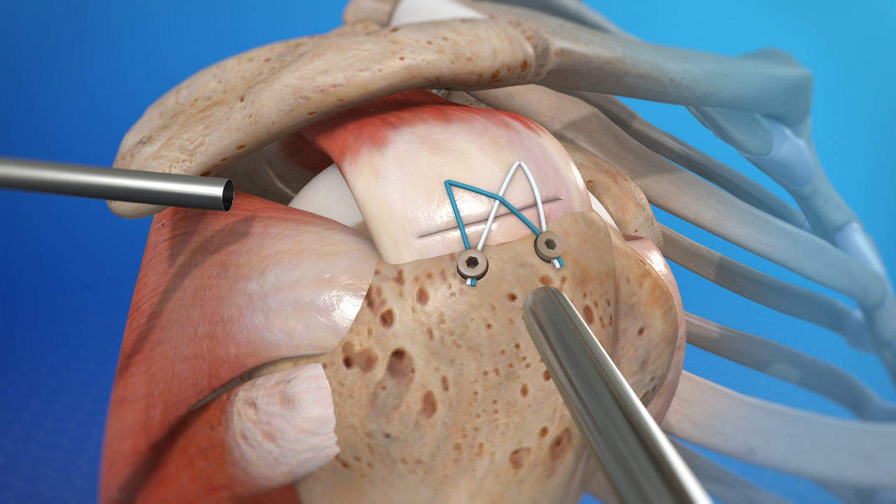 Rotator Cuff Tears Adam Watson Orthopaedic Surgeon