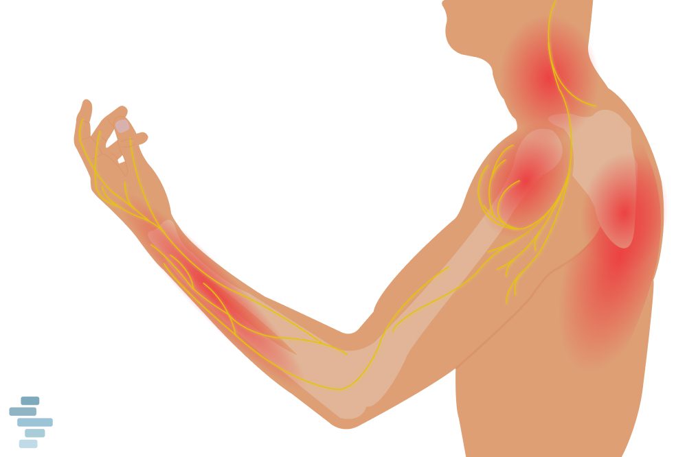 Cervical Radiculopathy