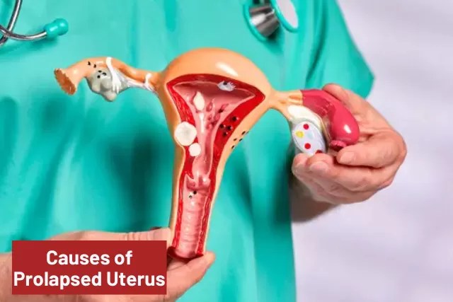 Prolapsed Uterus Causes Symptoms Stages And Treatment