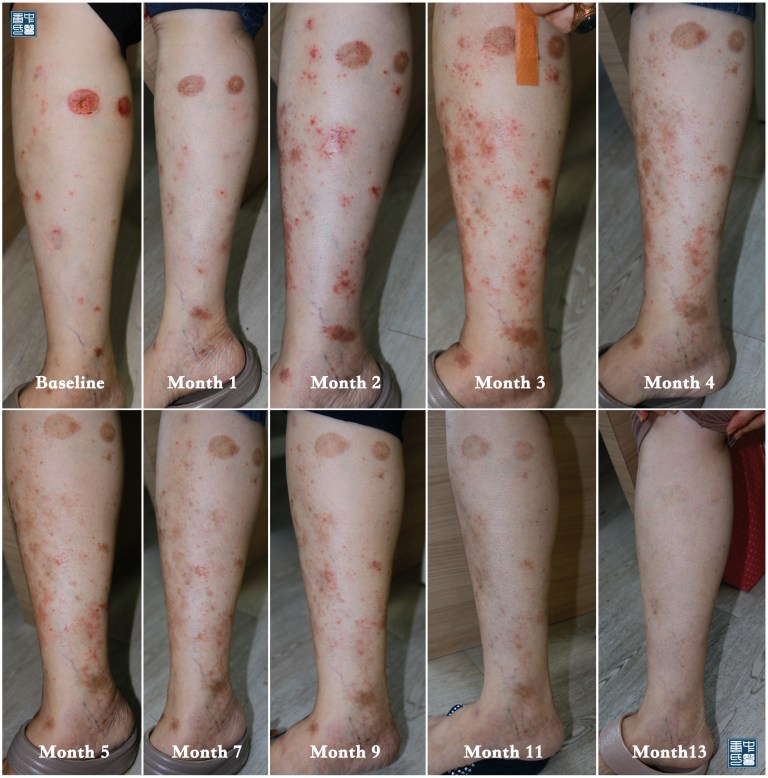 A Case Of Recalcitrant Acute Eczematous Dermatitis Resolving With