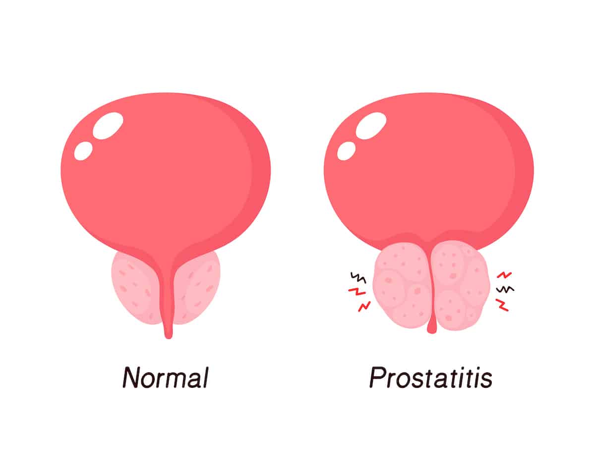 Chronic Prostatitis Treatment Options