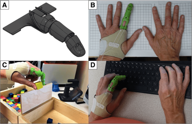 Case Study A 3d Printed Patient Specific Partial Finger Prosthesis