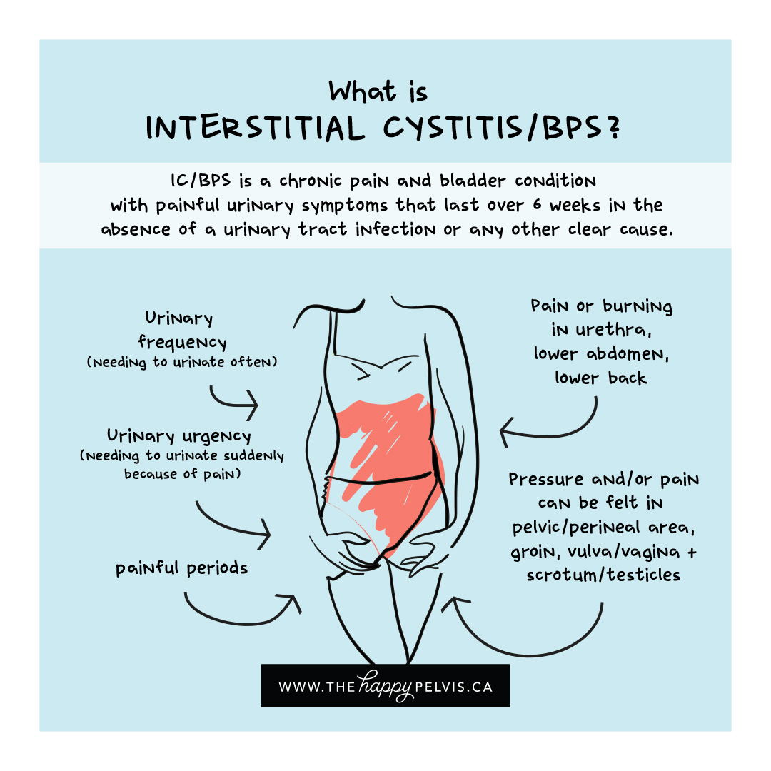 Men And Interstitial Cystitis The Happy Pelvis