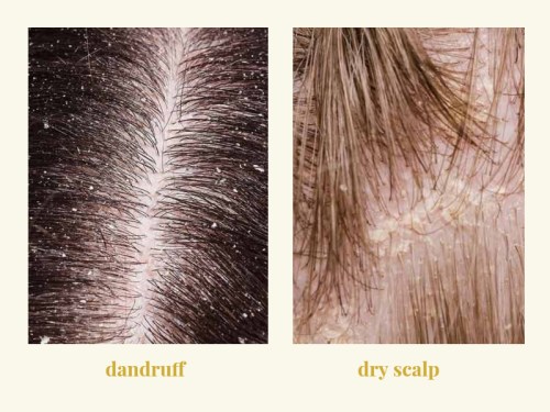 10 Dandruff Flakes Vs Dry Scalp Flakes Fashionblog