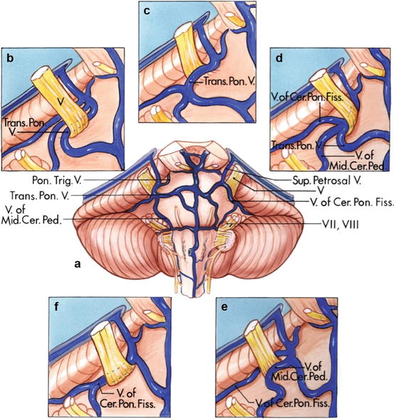 Microsurgical Anatomy For Microvascular Decompression Surgery