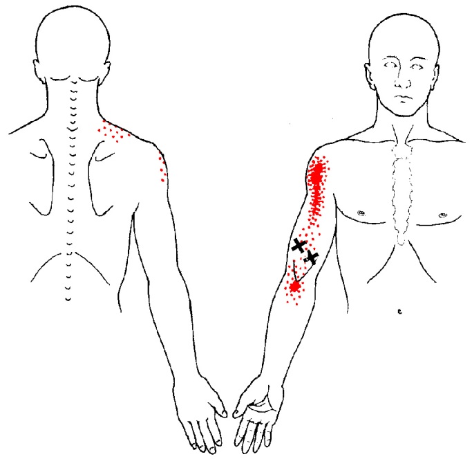 Biceps Trigger Points And Referred Pain Pattern