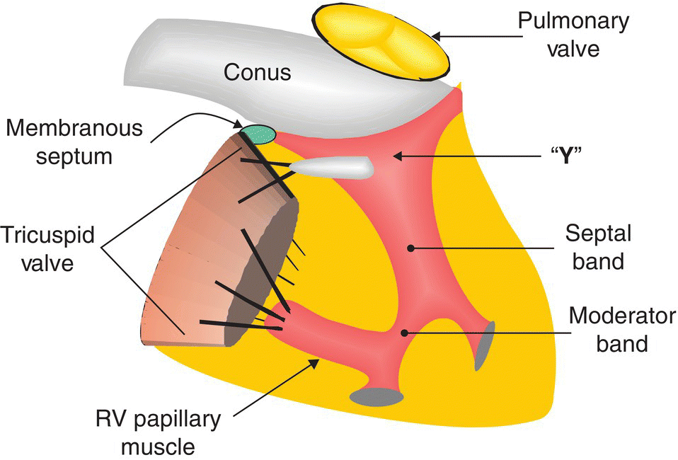 13 Ventricular Septal Defects Veterian Key