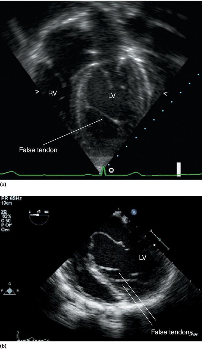 20 Anomalies Of The Left Ventricular Outflow Tract And Aortic Valve