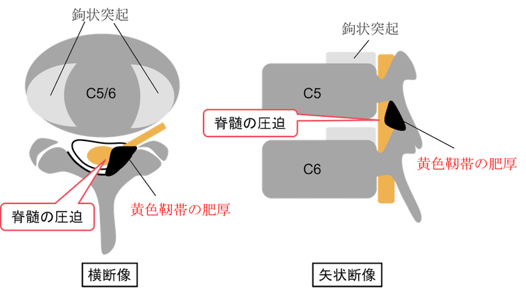 頚椎症性神経根症・脊髄症とは？症状は？mri画像と図を用いて解説！