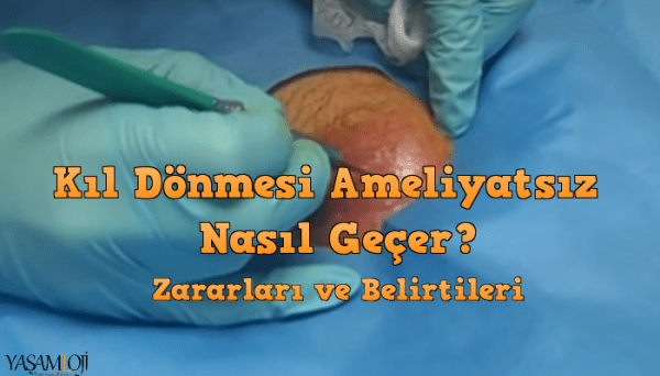 Kıl Dönmesi Neden Olur Ve Nasıl Geçer Yasamloji