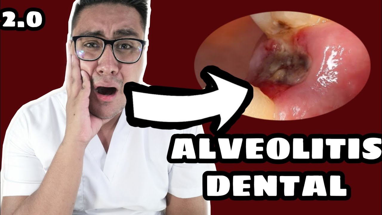 Que Es La Alveolitis Dental Seca Y Como Tratarla Estudi Dental Otosection