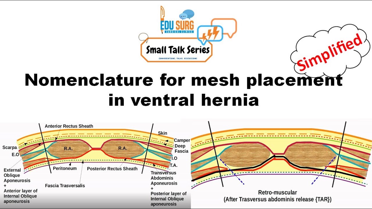 Robotic Ventral Hernia Repair With Mesh Placement End