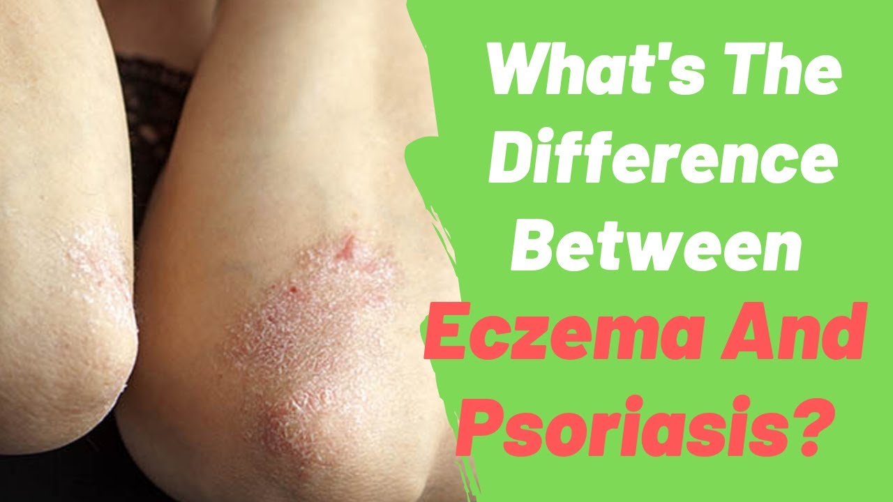 What Makes Psoriasis Different From Eczema And How Is It Treated