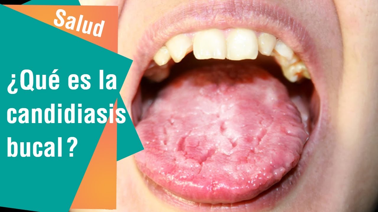 Como Detectar Y Como Tratar La Candidiasis Bucal Otosection