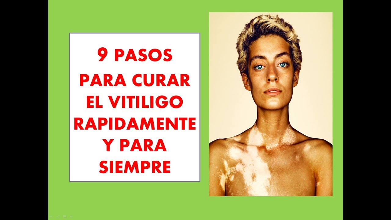 Que Es Y Como Se Cura El Vitiligo Otosection