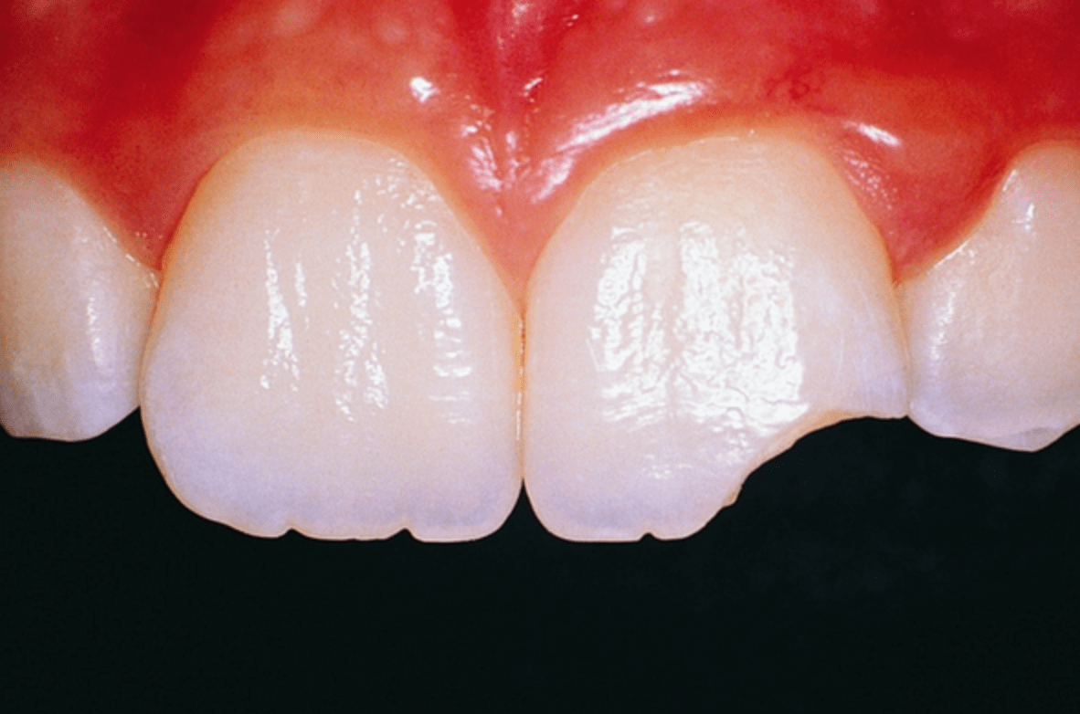 Dental Trauma Core Em