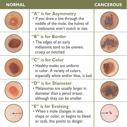 What Do Skin Cancers Types Look Like Cancerworld