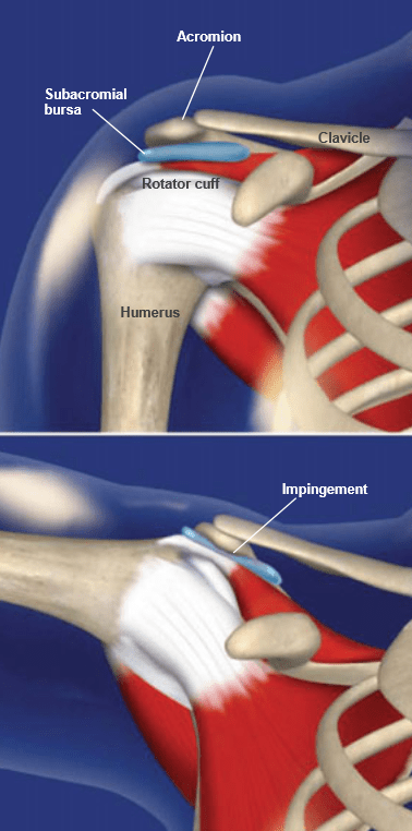 Shoulder Impingement Syndrome Central Coast Orthopedic Medical Group