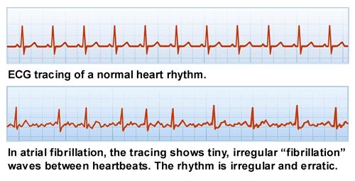 Understanding The Ekg Signal Atrial Fibrillation Resources For Patients