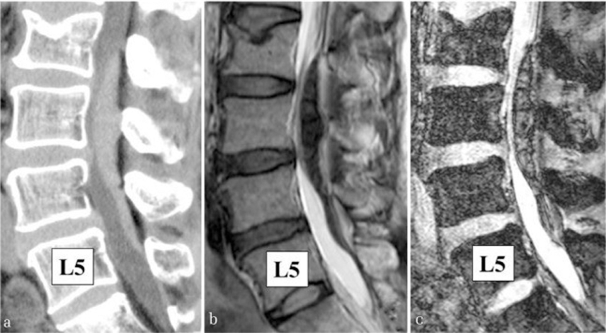 Complications Of Minimally Invasive Lumbar Decompression Mild