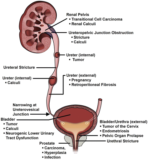 Dilation Of The Ureters And Bladder Pictures