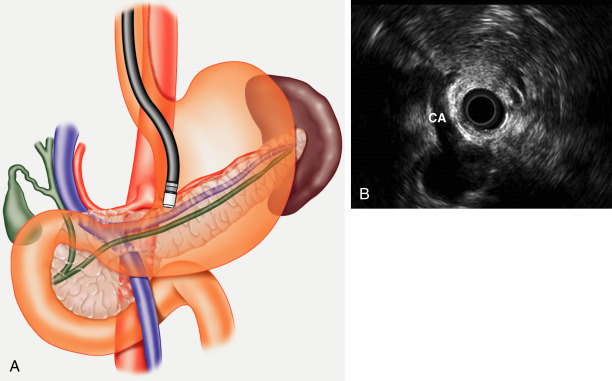 How To Perform Endoscopic Ultrasonography In The Pancreas Bile Duct