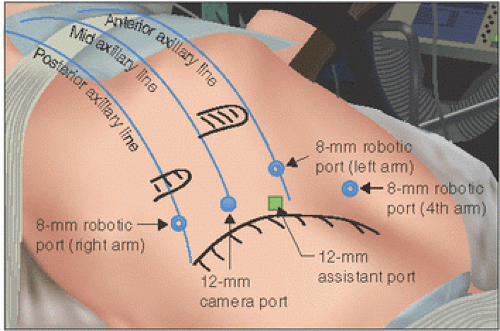 Laparoscopicrobotic Nephrectomy And Partial Nephrectomy Abdominal Key