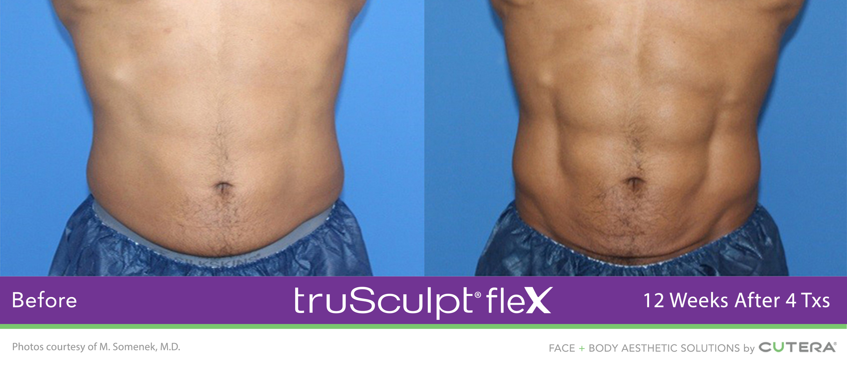 Trusculpt® Flex Personalized Muscle Sculpting Treatment Pittsburgh