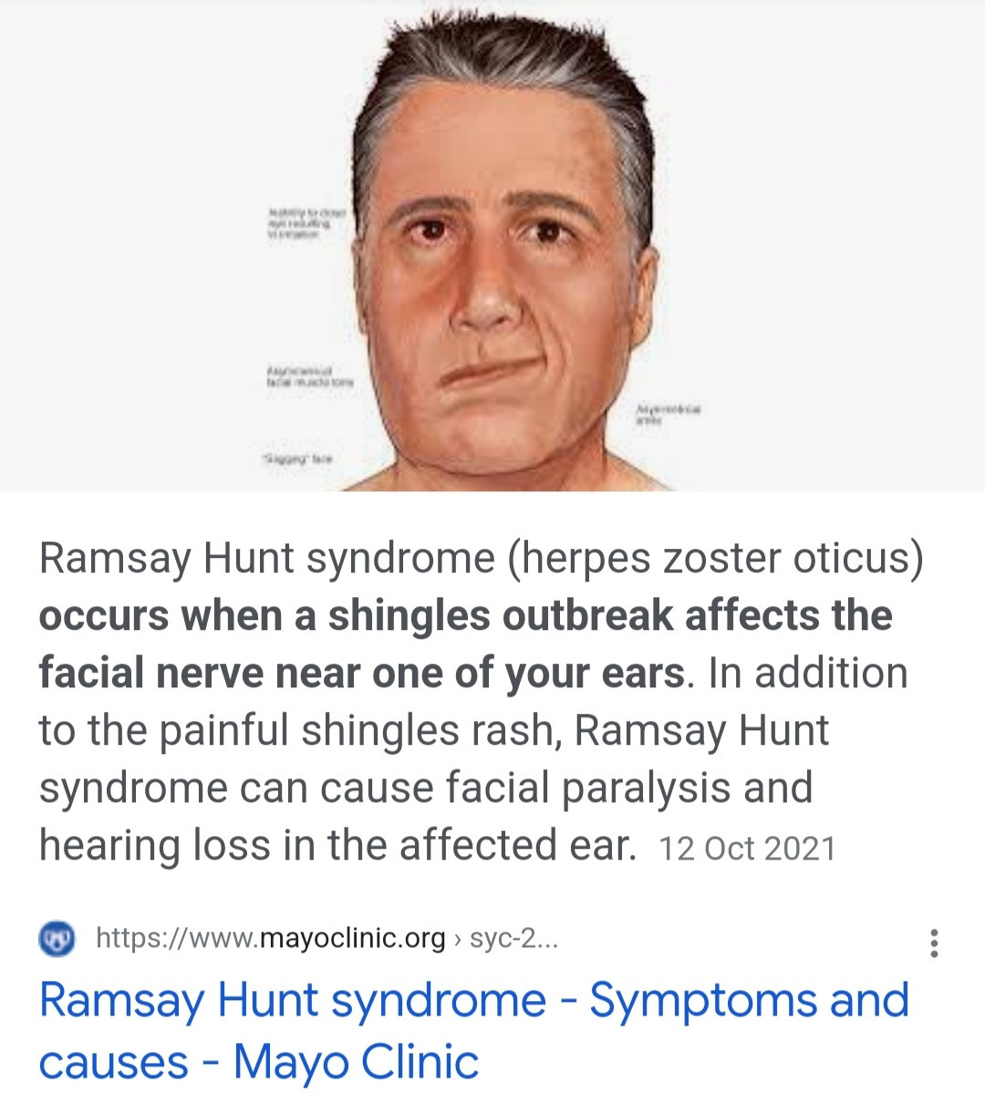 Ramsay Hunt Syndrome Mv6b Qcd905odm Anna Hueber