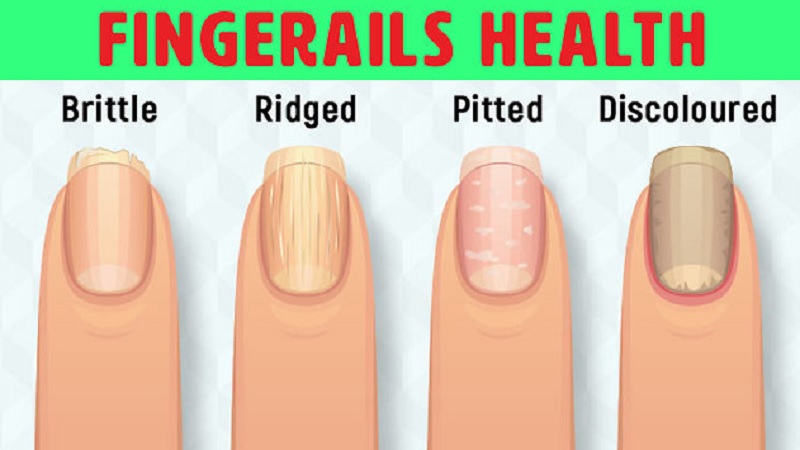 8 Things Your Nails Can Tell You About Your Health Video